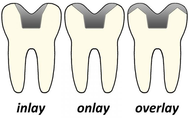 Seri Artikel Dental ‘Apa Sih Yang Dilakukan Oleh Dokter Gigi’ : Inlay ...